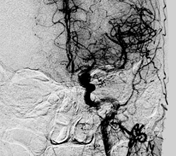 Surgical Simulation Models | Aneurysm Clipping | Surgeonslab